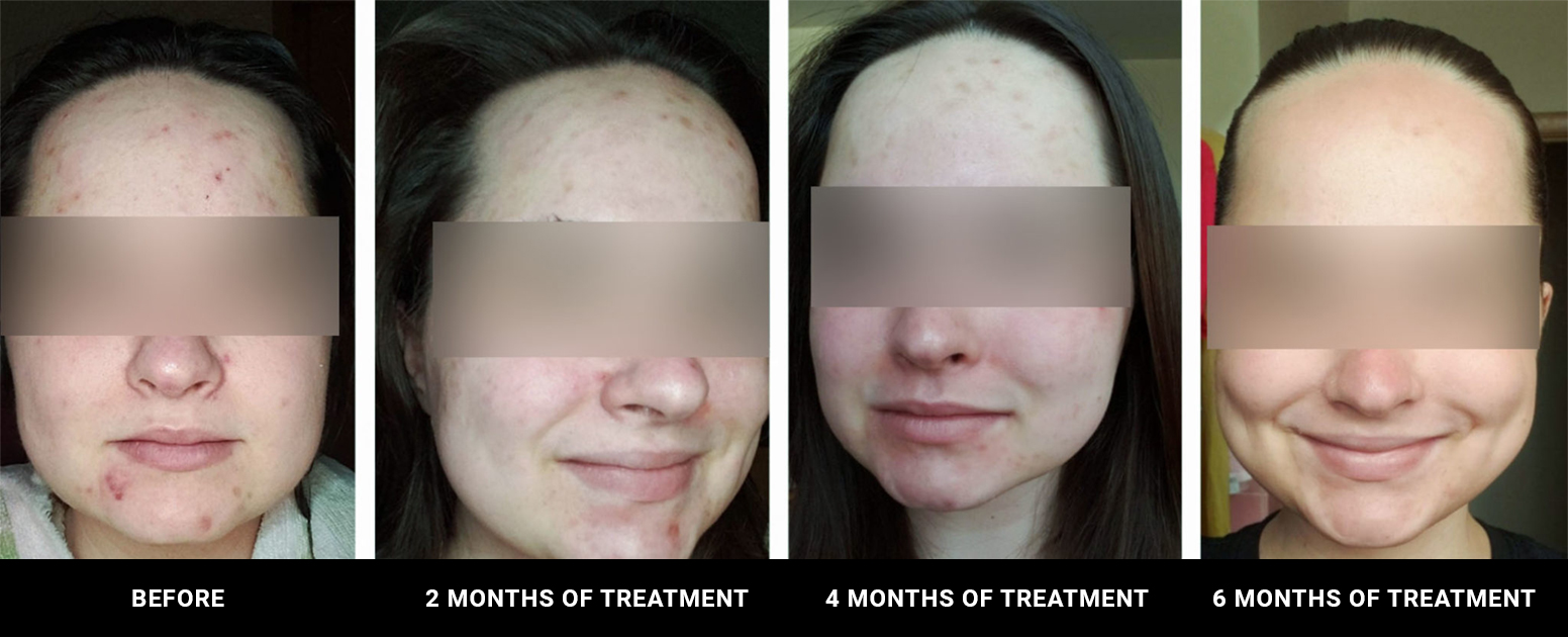 5 Advantages of PRP Treatment - New You Chicago